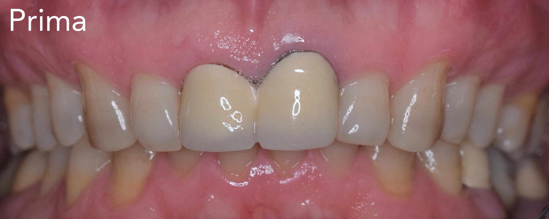 Ho perso dei denti, quale tra protesi fissa o rimovibile è la migliore?